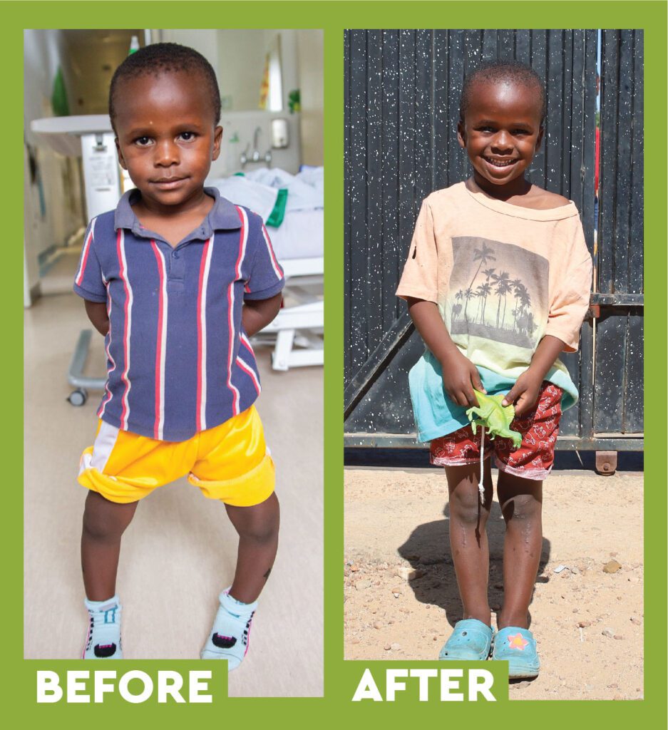 Surgery Provides Freedom to Walk: A Mother’s Joy, A Child’s Triumph ...